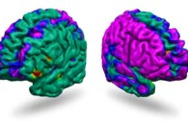 Scientists See the Foreshadowing of Depression in Brain Anatomy ...