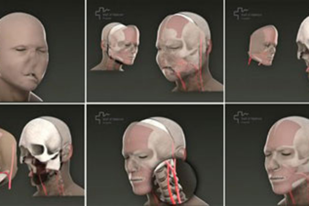 First Full Face Transplant--Jaw, Nose, Teeth, Etc--Declared a Success ...