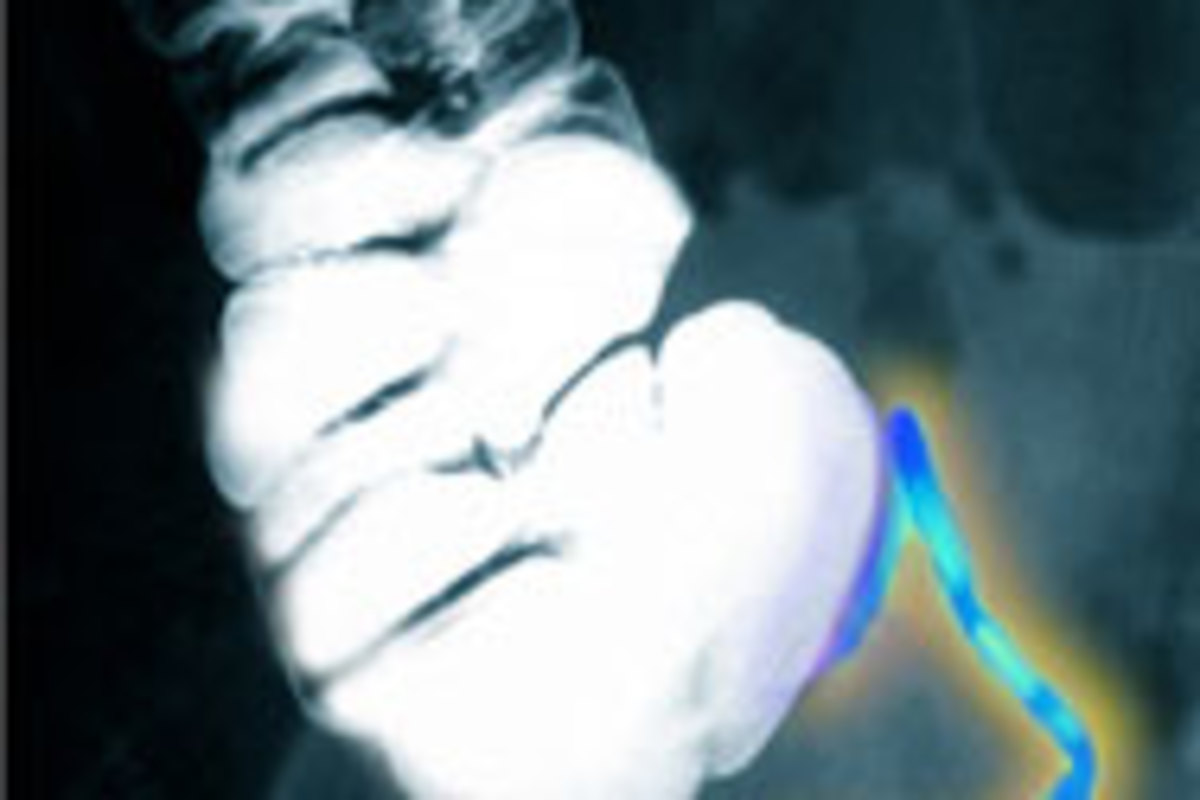 Your Appendix: The Enigma Inside You | Discover Magazine
