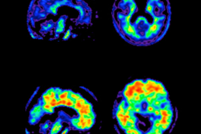 #10: Early Diagnosis for Alzheimer's | Discover Magazine