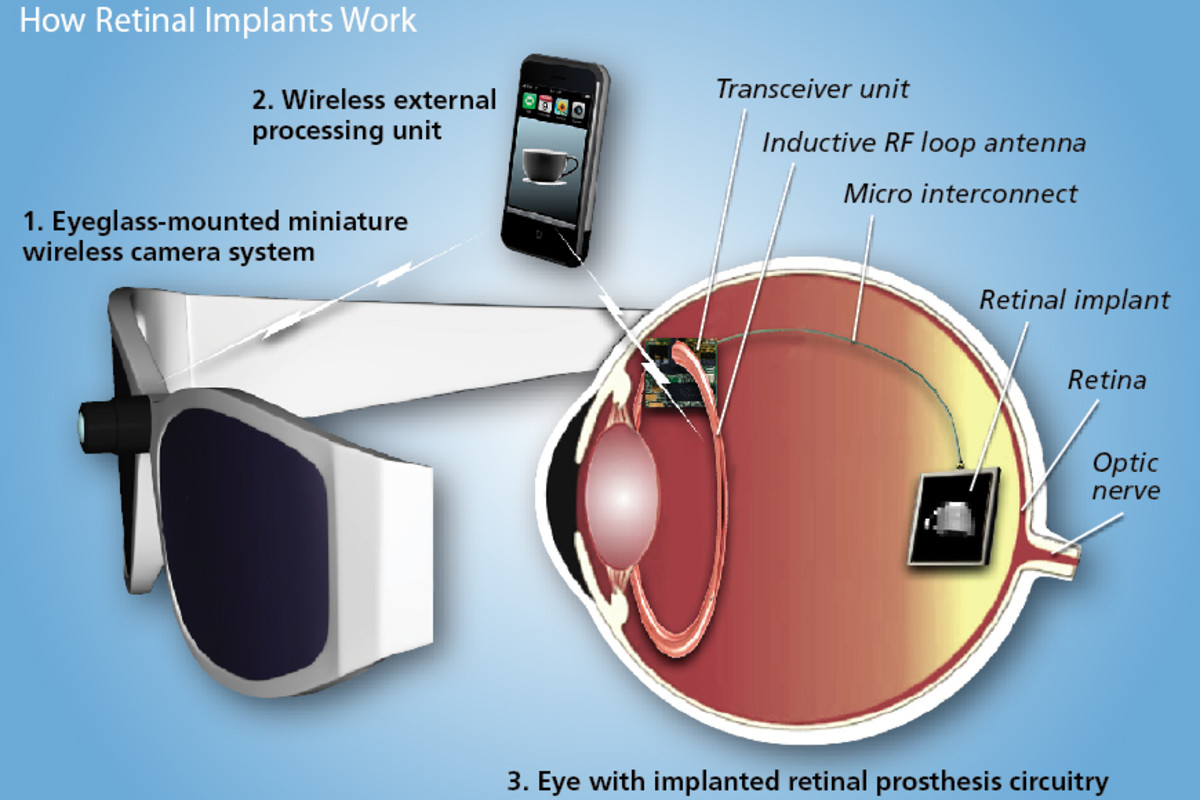 Retinal Implants Get an Upgrade | Discover Magazine