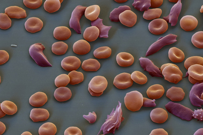 Sickle Cell Anemia Patients Get a Partial Reprieve | Discover Magazine