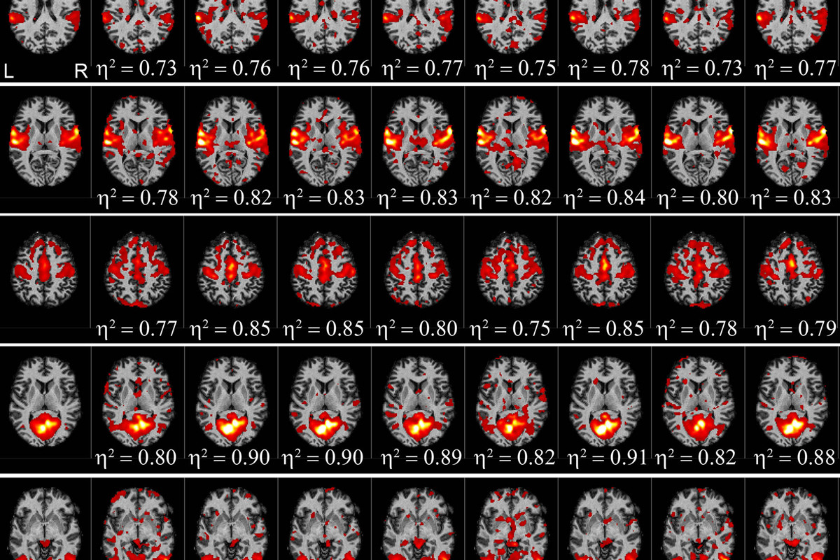 When Brain Imaging Goes Awry | Discover Magazine