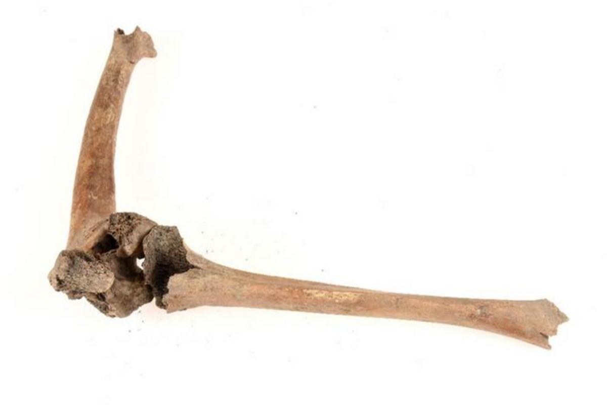 Medieval Skeleton Reveals What Life Was Like With a Disability in the ...