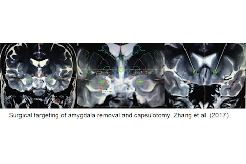 "Can I Have My Amygdala Removed?" | Discover Magazine