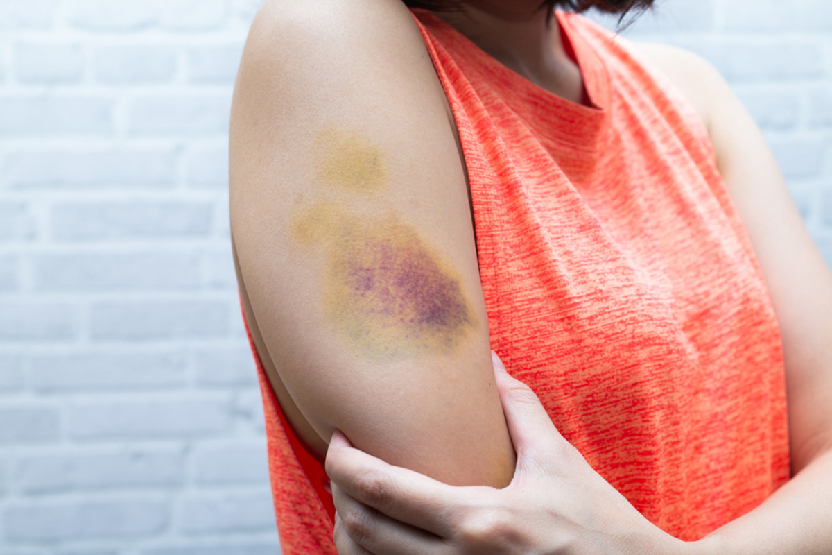 Why do Bruises Turn Yellow, Purple and Green? | Discover Magazine