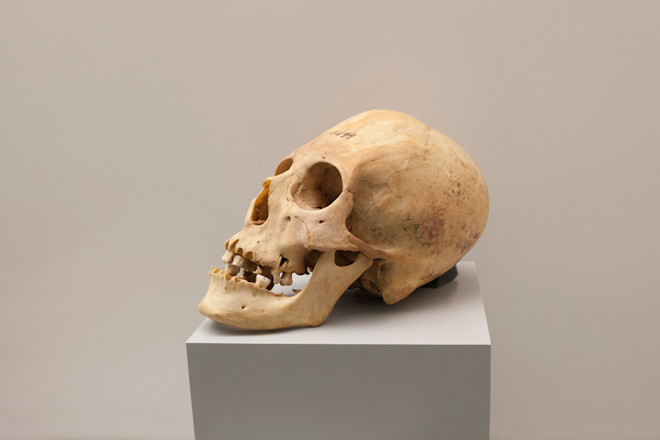 Tracing the History and Health Impacts of Skull Modification | Discover ...
