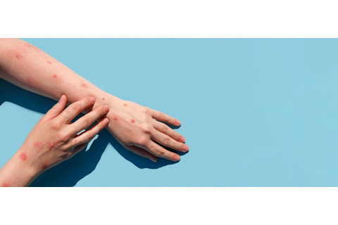 What Is Monkeypox and Should we Still be Worried About this Virus ...