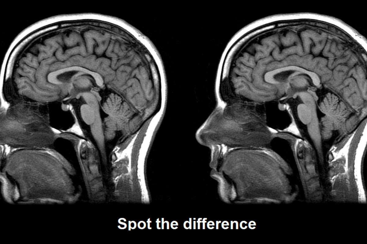 Most Autistic People Have Normal Brain Anatomy | Discover Magazine