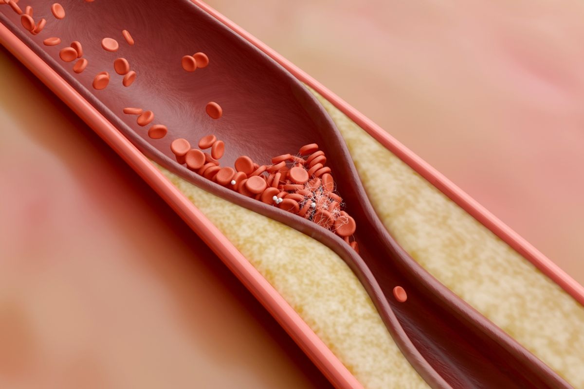 More Effective and Safe Blood Thinning Drug May Soon Replace Low-Dose ...