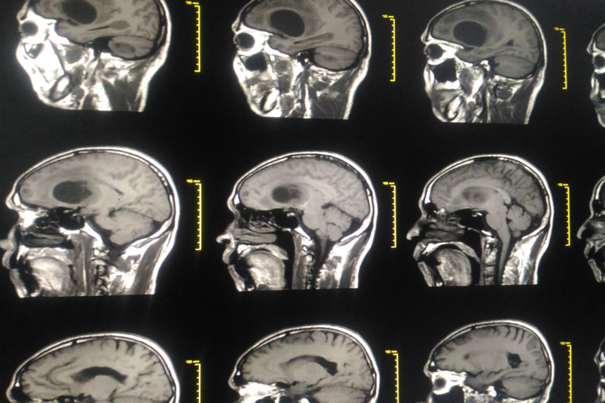 Glioblastoma Is the Most Aggressive Brain Cancer and May One Day Be ...