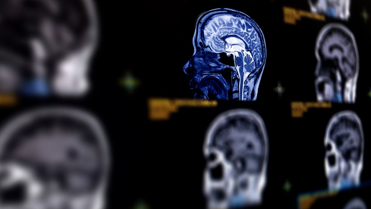 Tumors May Not Develop Randomly Across the Brain — Fruit Flies May Help ...