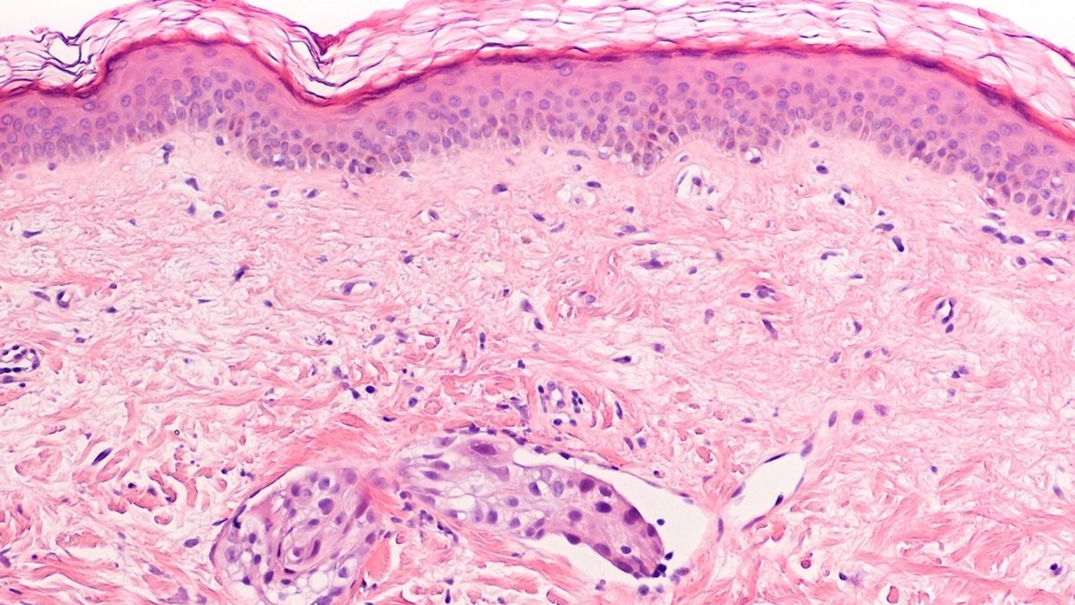Weight Loss Drugs Like Ozempic May Lower Breast Cancer Risk and Slow ...