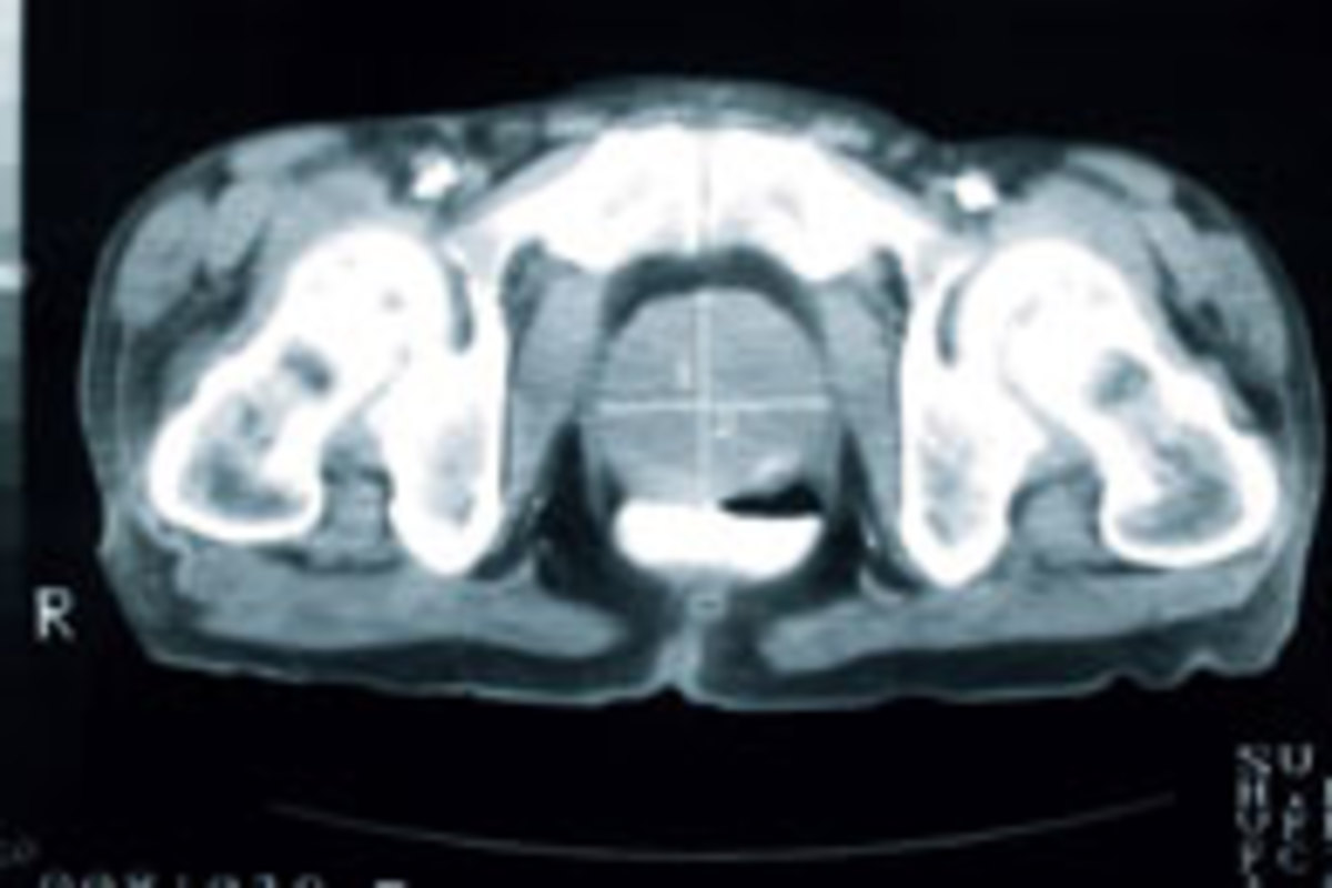 Prostate Cancer Drug Shows Promise for "Untreatable" Patients ...